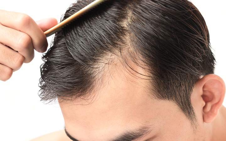 Does Nicotine Cause Hair Loss? Understanding the Link