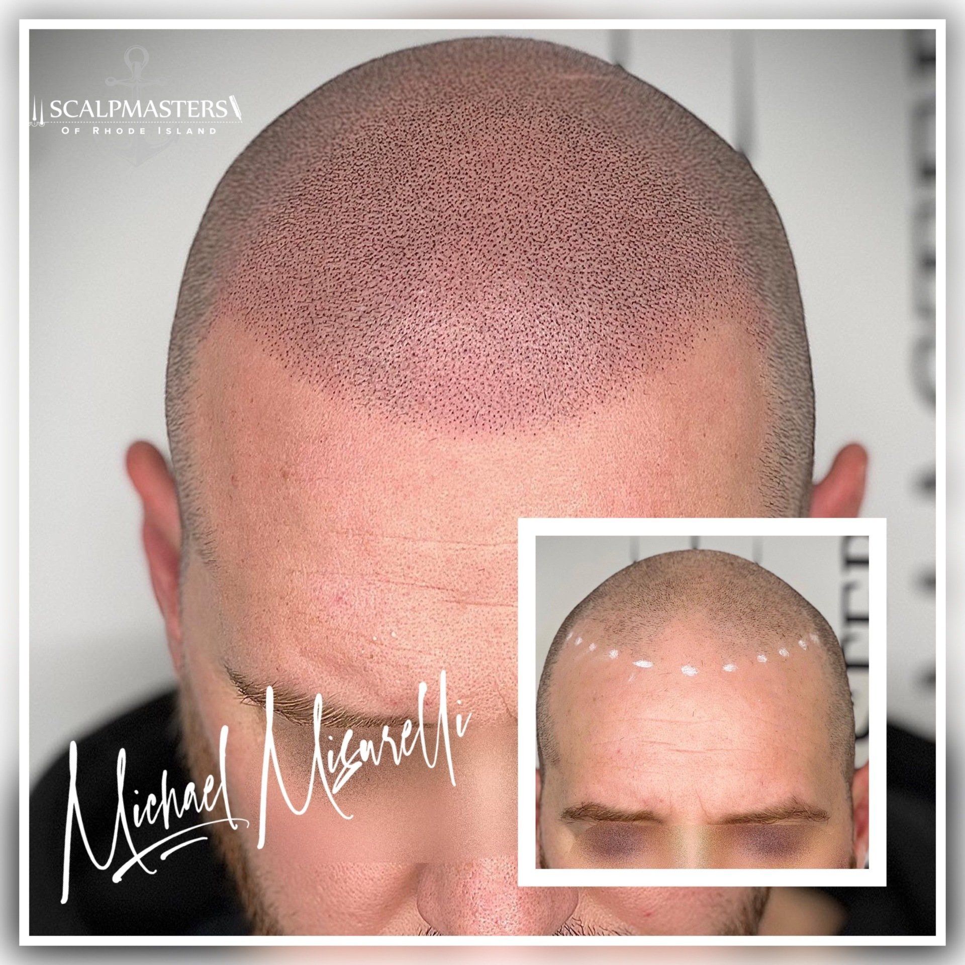 A Comprehensive Guide on Choosing the Right SMP Hairline