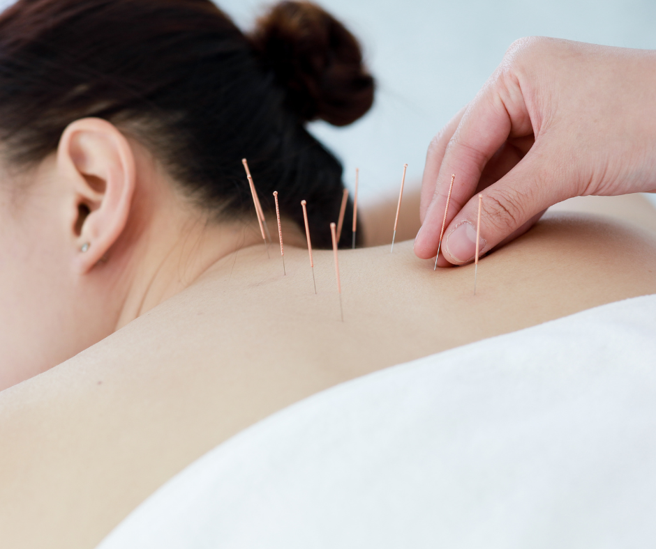The Power of Acupuncture: Ancient Healing for Modern Health