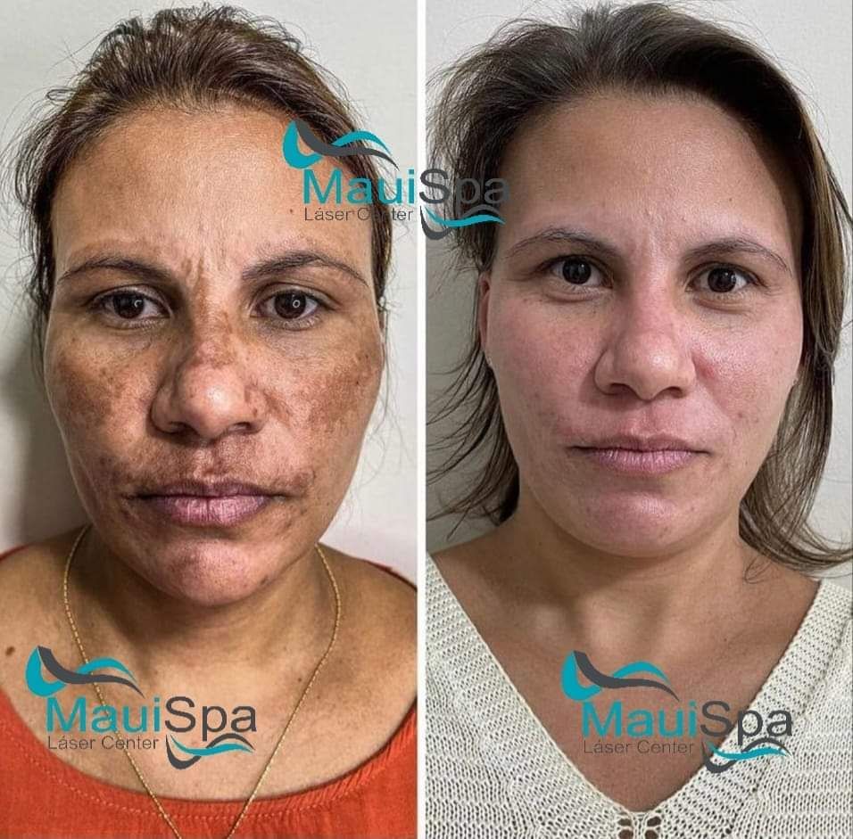 Cuidado de la piel - Maui Spa Láser Center