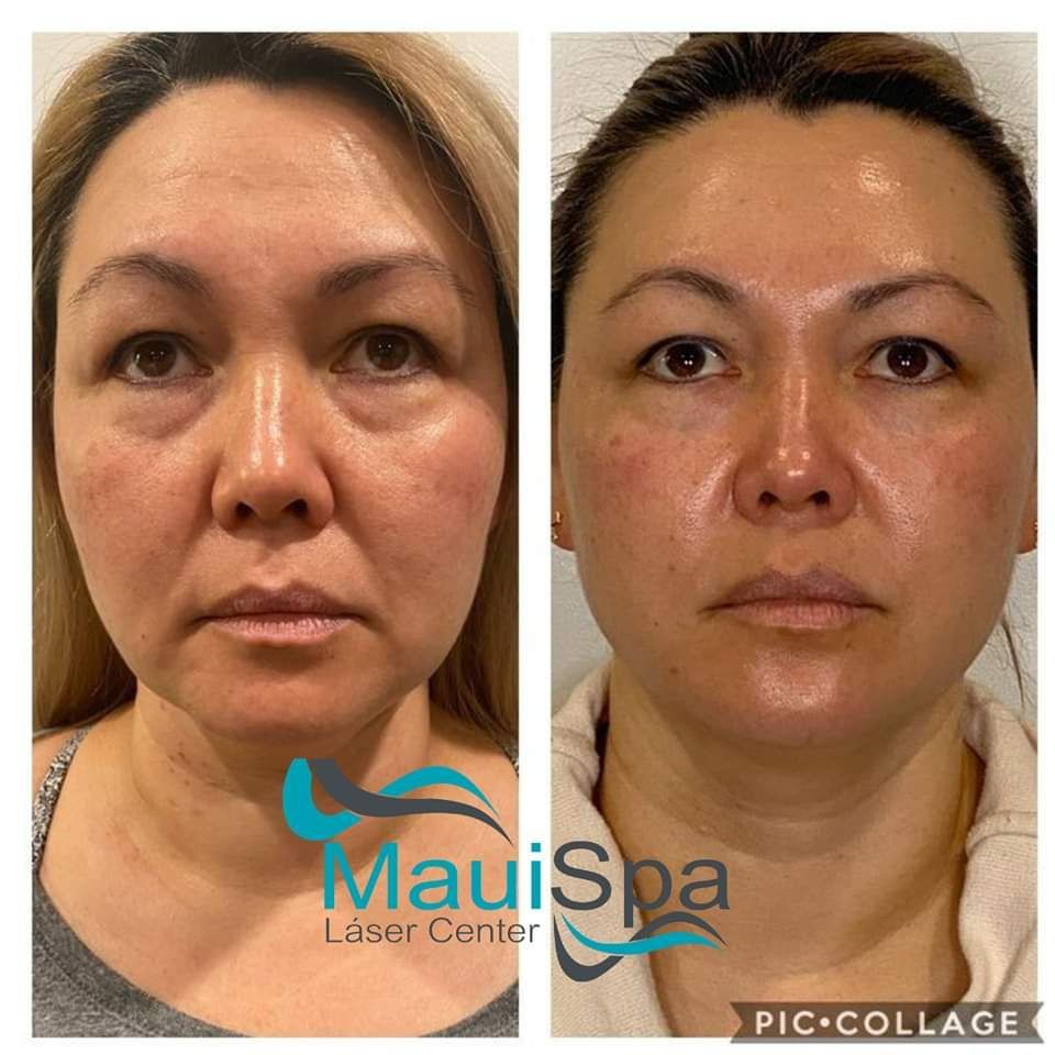 Cuidado de la piel - Maui Spa Láser Center