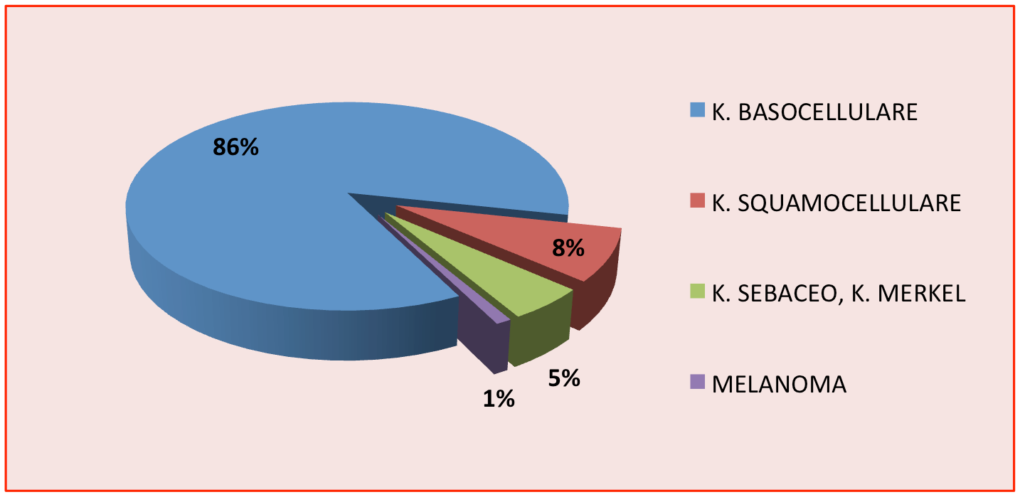 Carcinoma a cellule basali | Firenze | Santoro Dott. Nicola