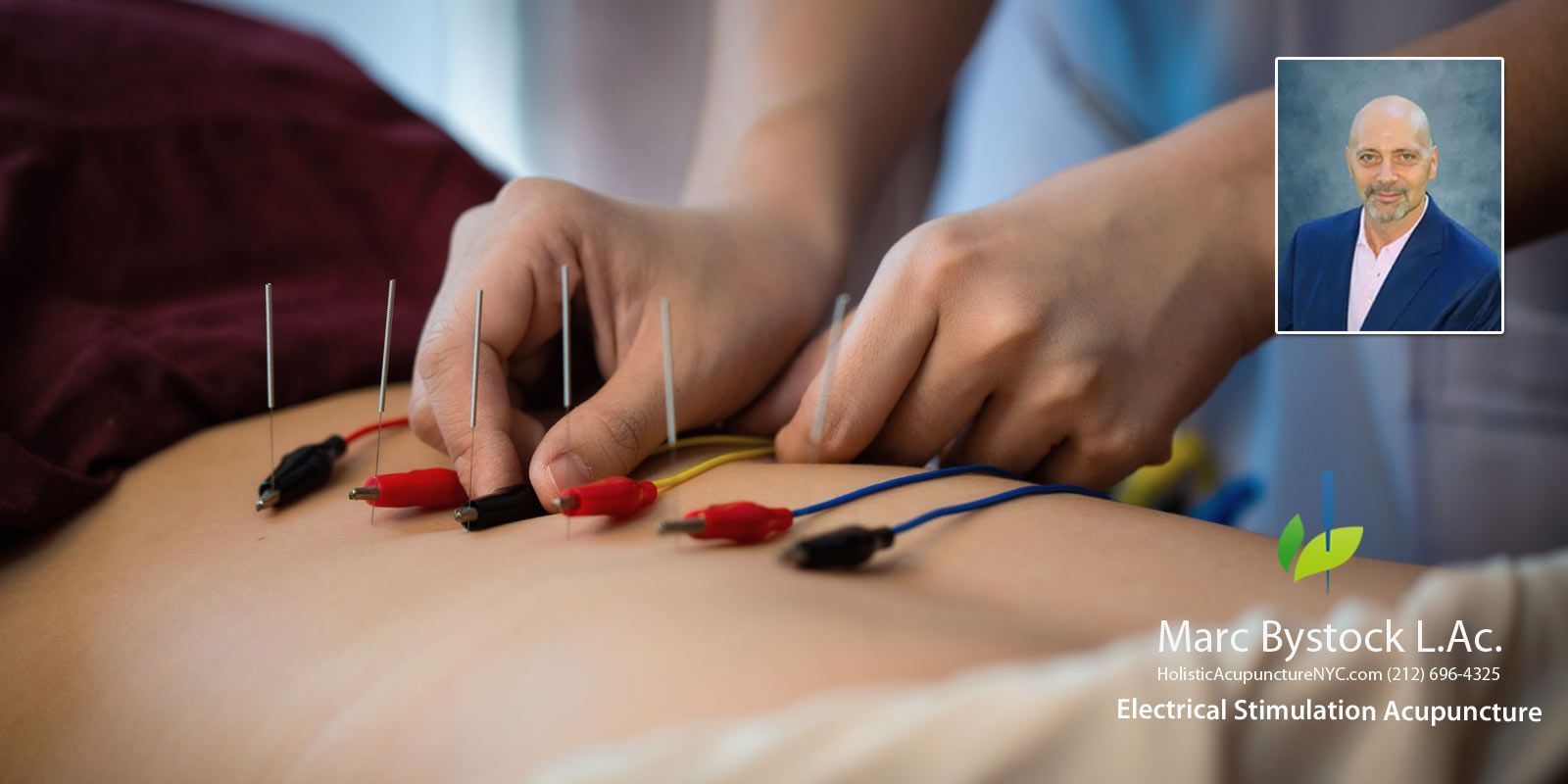 Electrical Stimulation Acupuncture NYC by Marc Bystock L.Ac.