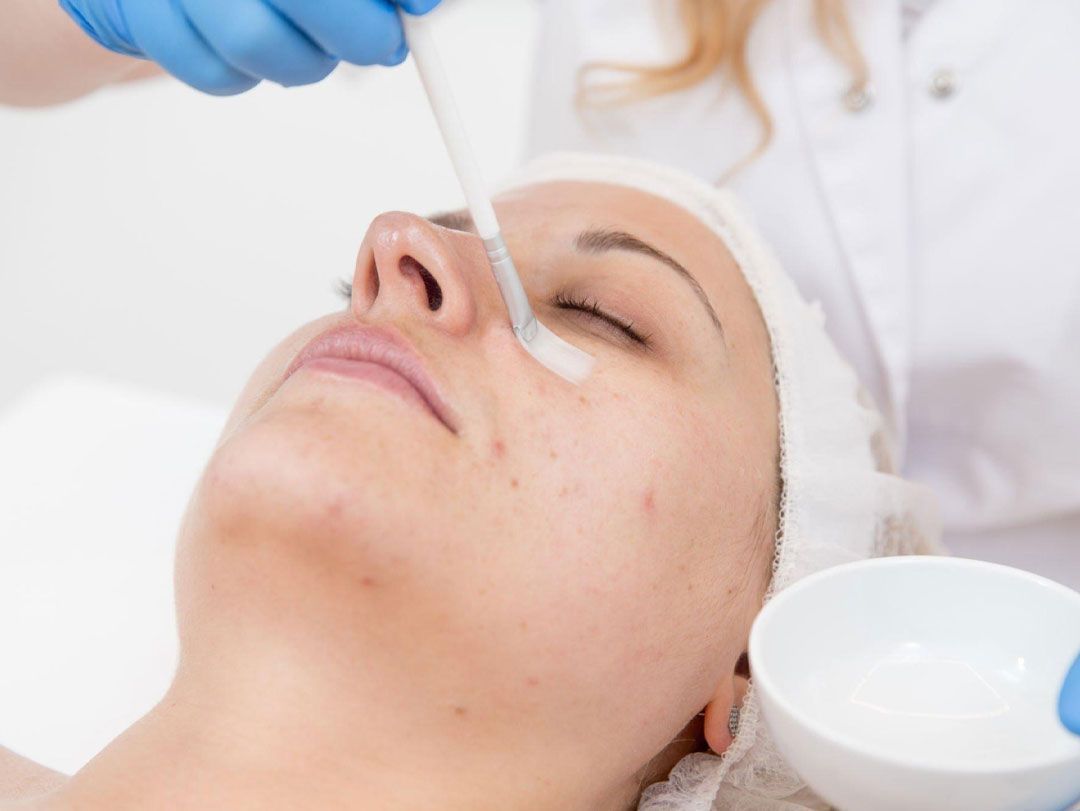 Some Benefits of Chemical Peels for Acne-Prone Skin | Blog