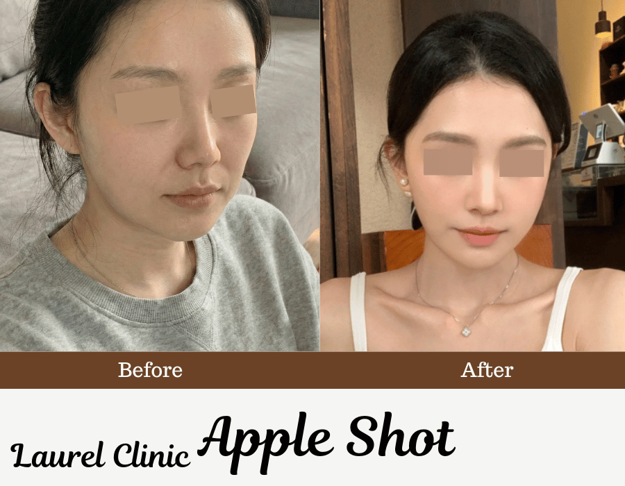 Shurink vs Ultherapy vs Thermage