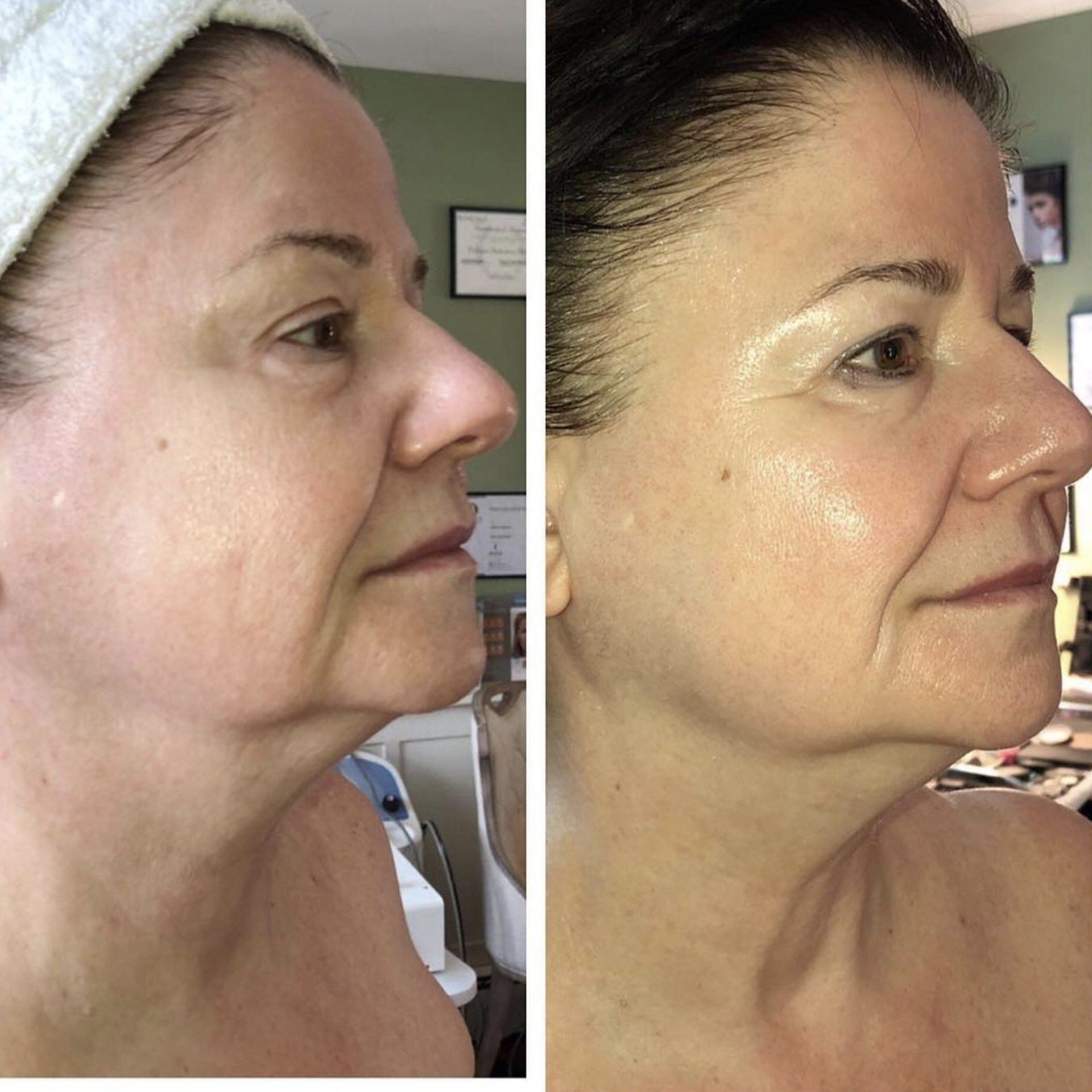 Before & After | Advanced Microcurrent Science for Anti-Aging