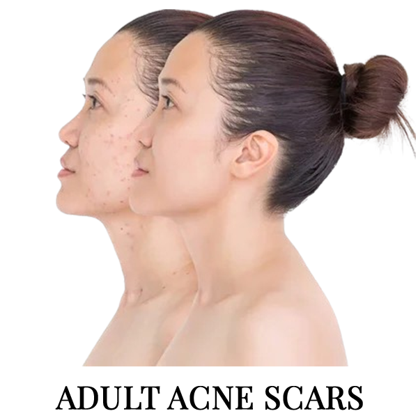 Efficient Solutions For Adult Acne Scars Malka Spa