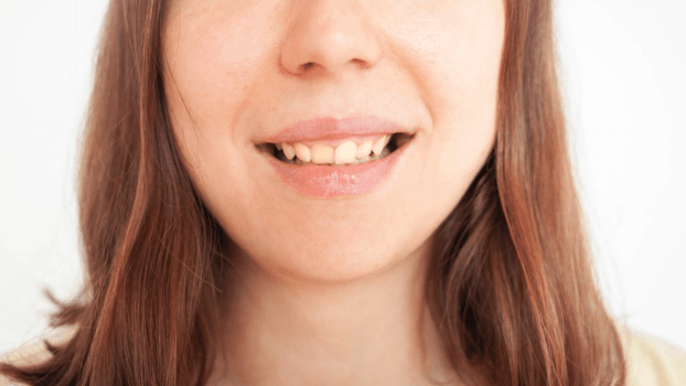 Yellowing Teeth: The Causes & Ways to Prevent It