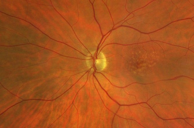 Macular Degeneration Causes & Treatment | Southside Eye Centre