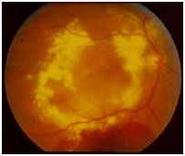 ARMD | Macular Degeneration | Cape Fear Retina | Wilmington