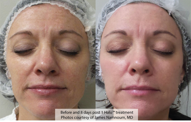 Sallow Skin Before And After