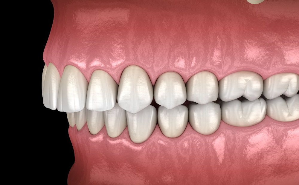 Malocclusions In Comox, BC | Types Of Teeth Misalignments
