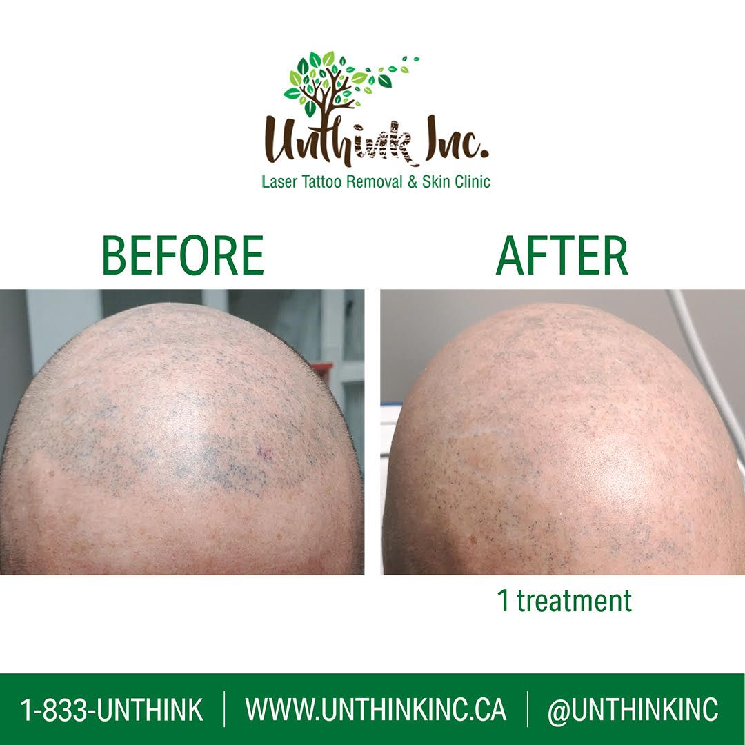 Perfect Your Style: SMP Removal Techniques Explained