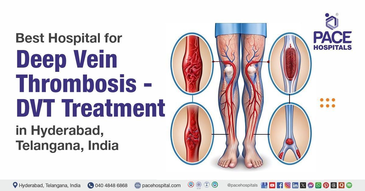 Best DVT Treatment in Hyderabad, India | Deep Vein Thrombosis