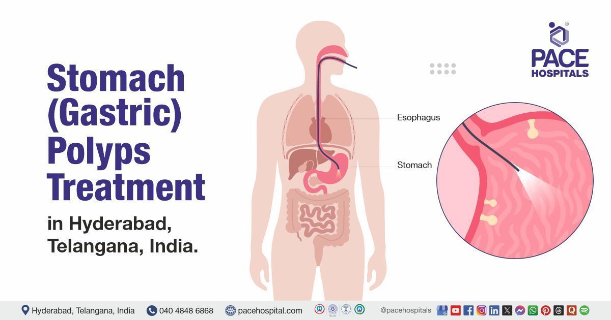 Best Hospital for Gastric Polyps Treatment in Hyderabad, India