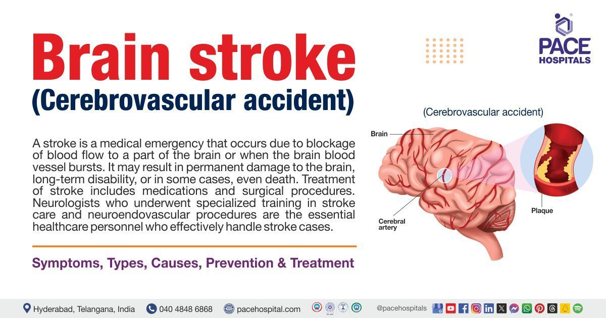Brain Stroke: Types, Causes, Symptoms, Prevention & Treatment