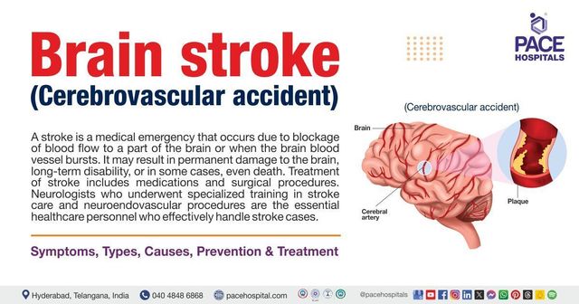 Stroke Reasons