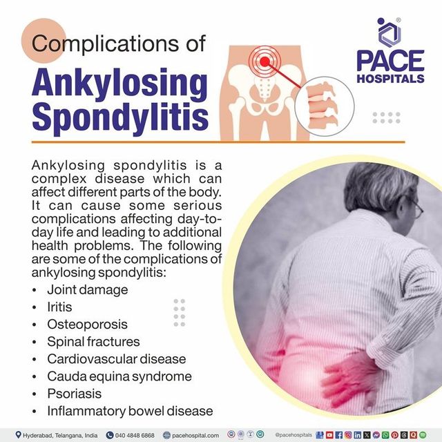 Ankylosing Spondylitis Patient