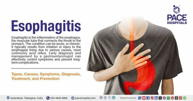 esophagus constriction causes