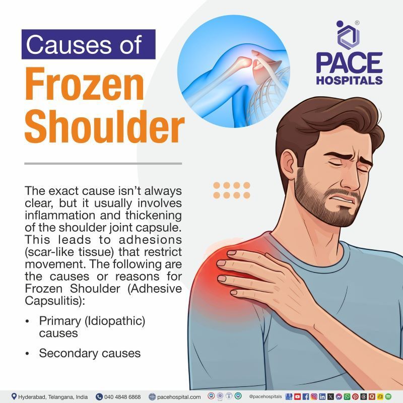 Frozen Shoulder: Types, Symptoms, Causes, Diagnosis & Treatment