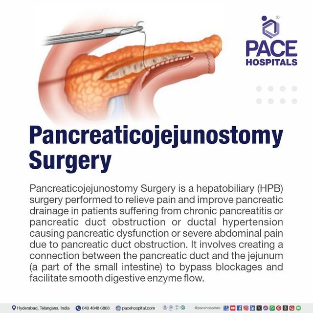 Puestow Procedure