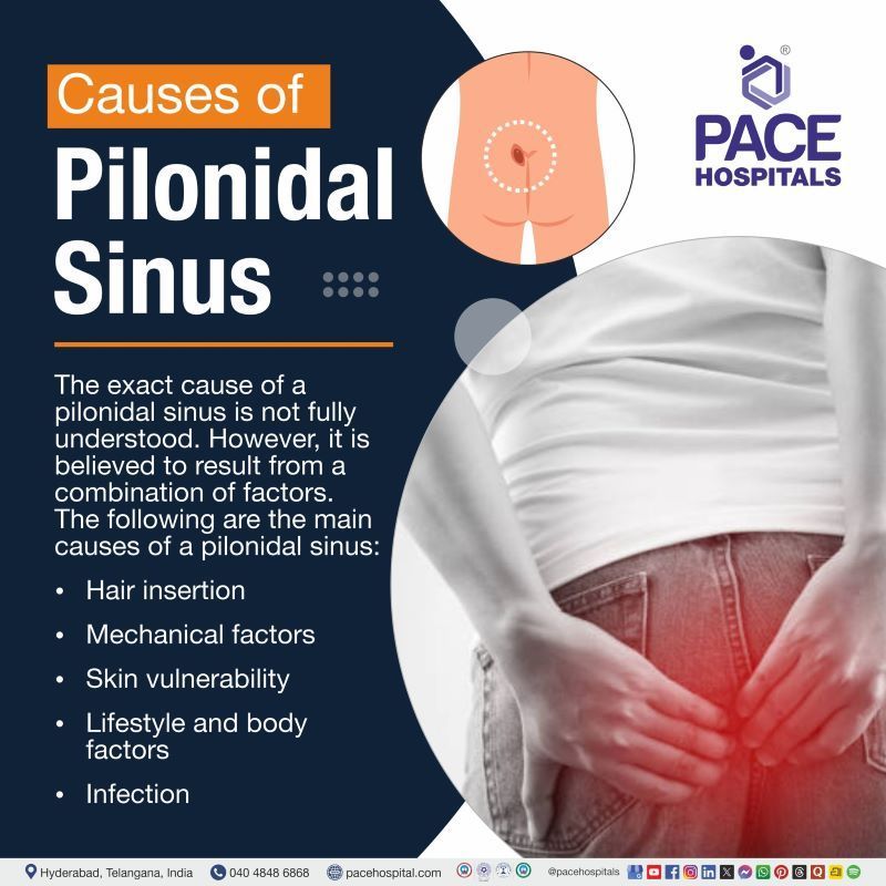 Pilonidal Sinus: Symptoms, Causes, Diagnosis & Treatment