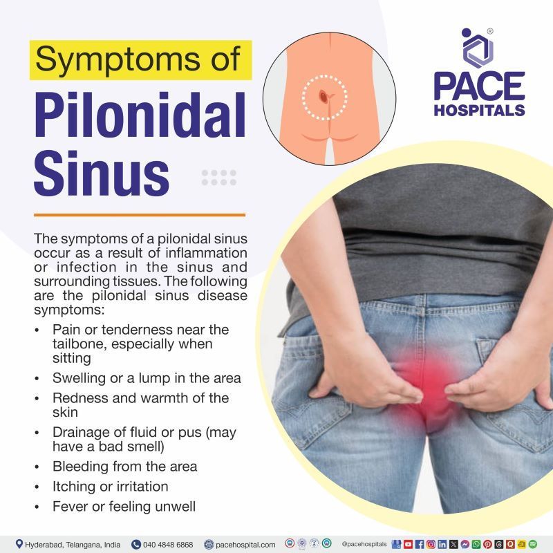 Pilonidal Sinus: Symptoms, Causes, Diagnosis & Treatment