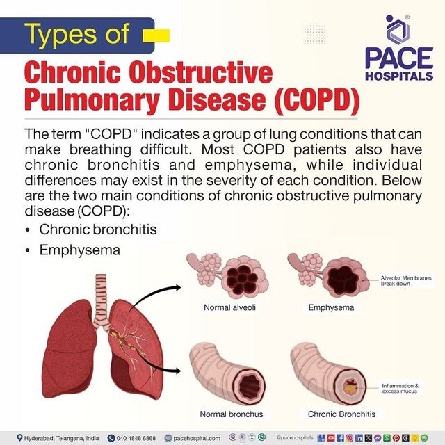 Understanding aging with COPD safely Natural Copd Treatments | Holistic Solutions for COPD