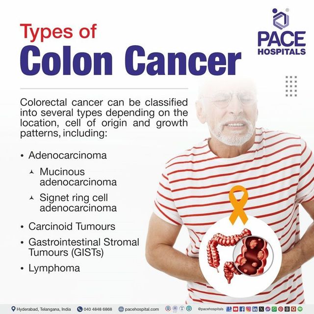 Colon Cancer Symptoms