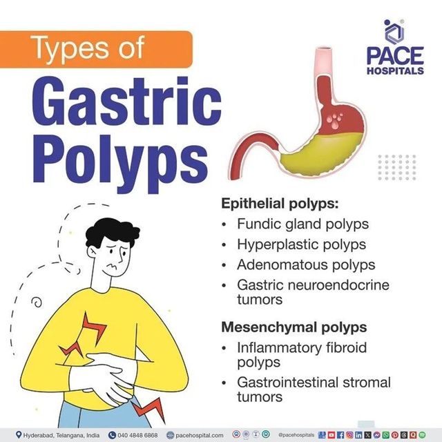 Hyperplastic Polyps Meaning