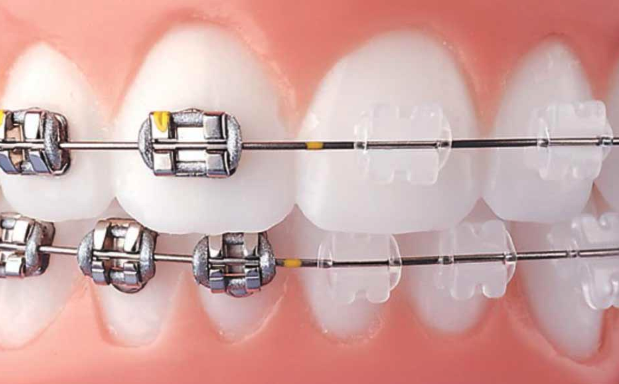Ceramic Braces vs. Metal Braces: Pros, Cons, and Cost