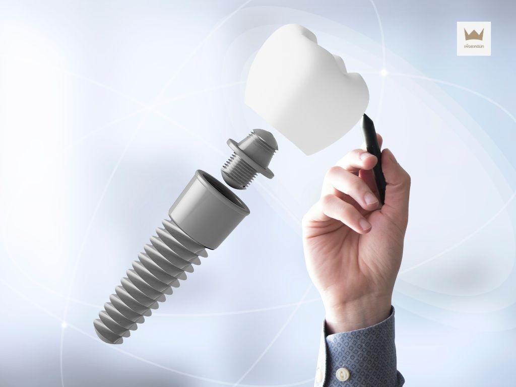 รากฟันเทียม Straumann เลือกรากฟันเทียมแบบไหนดี?