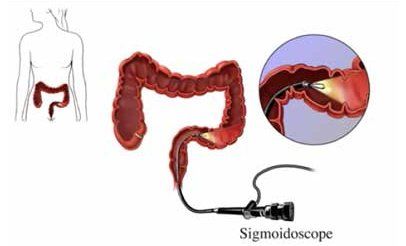 Flexible Sigmoidoscopy | Alfa Surgery Center
