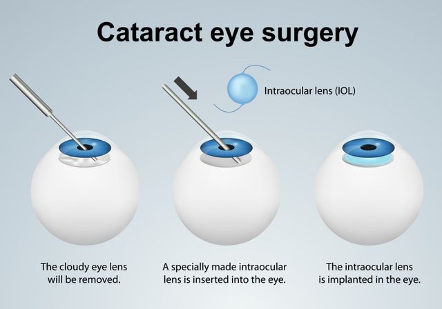 Is It Okay To Wear Eye Makeup After Cataract Surgery | Saubhaya Makeup