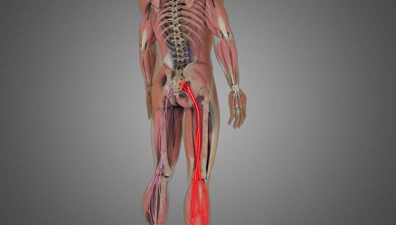 Lumbar Radiculopathy (SCIATICA)