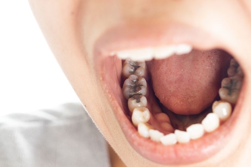 Decoding Different Types of Fillings: Weighing the Pros and Cons