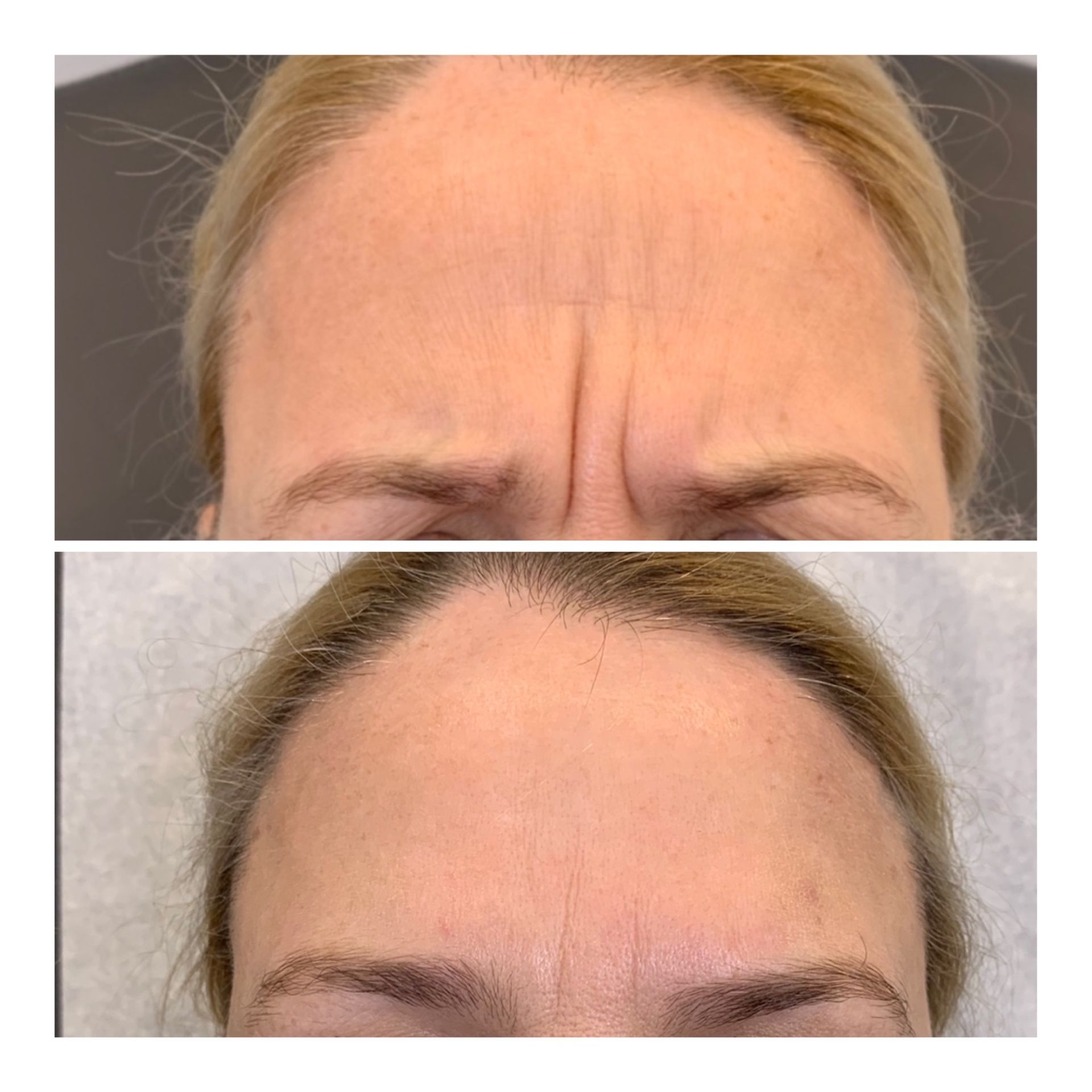 Understanding Neuromodulator Injections: What to Expect and How They Work