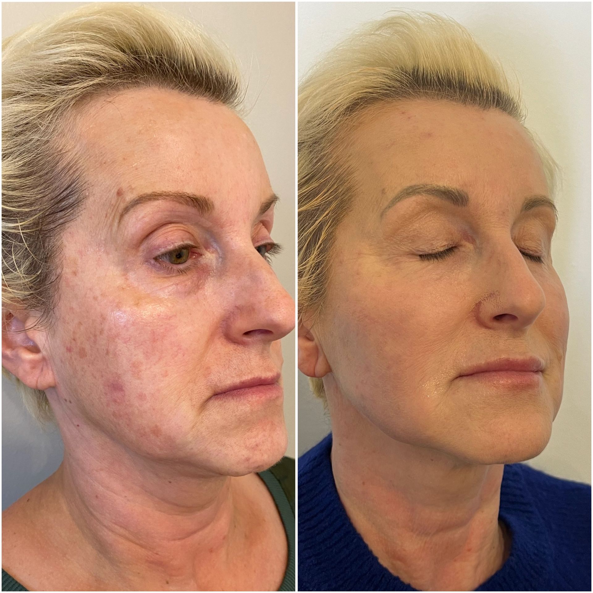 Laser Skin Treatments | London, ON | Bespoke Medical by Sonia Vilos