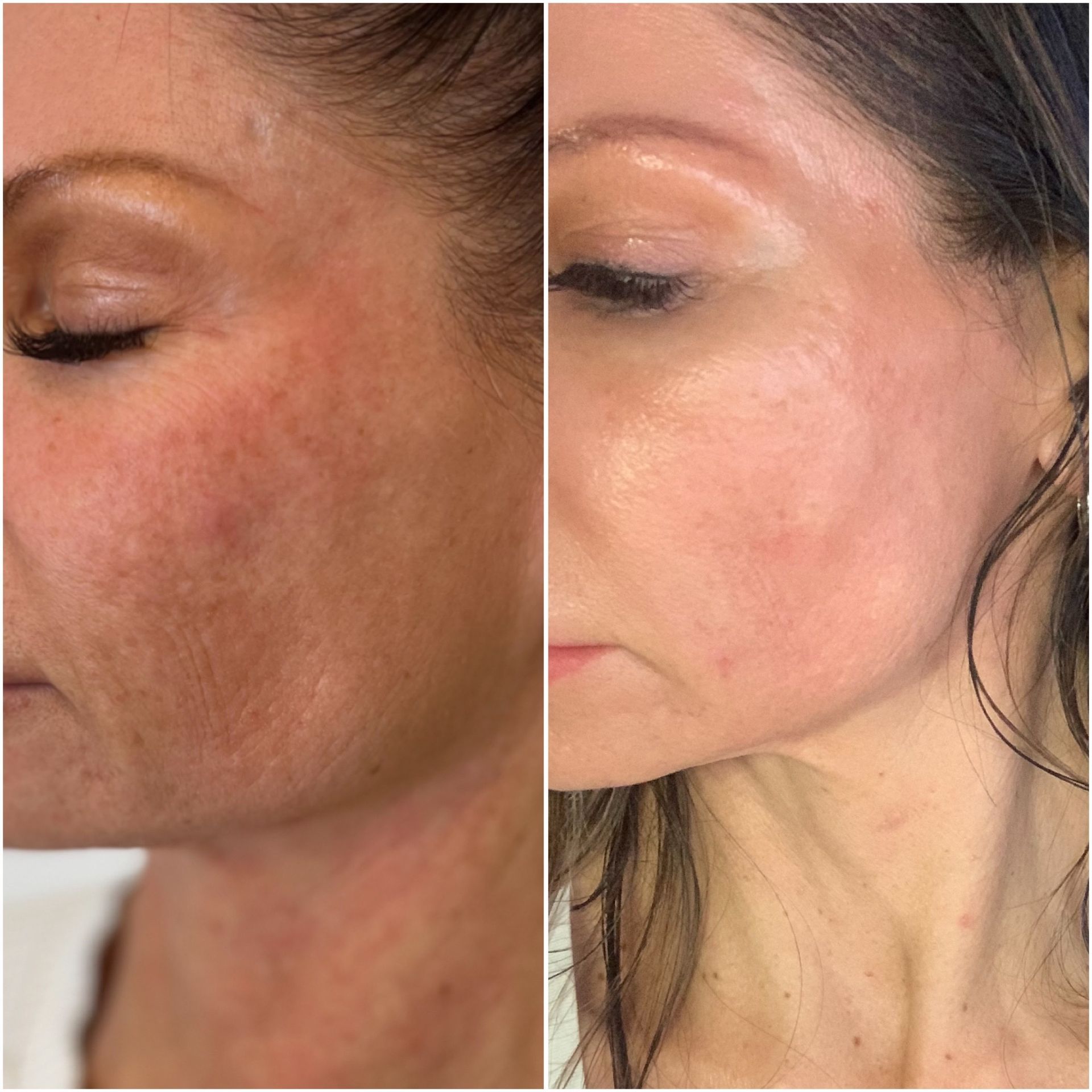 Laser Skin Treatments | London, ON | Bespoke Medical by Sonia Vilos