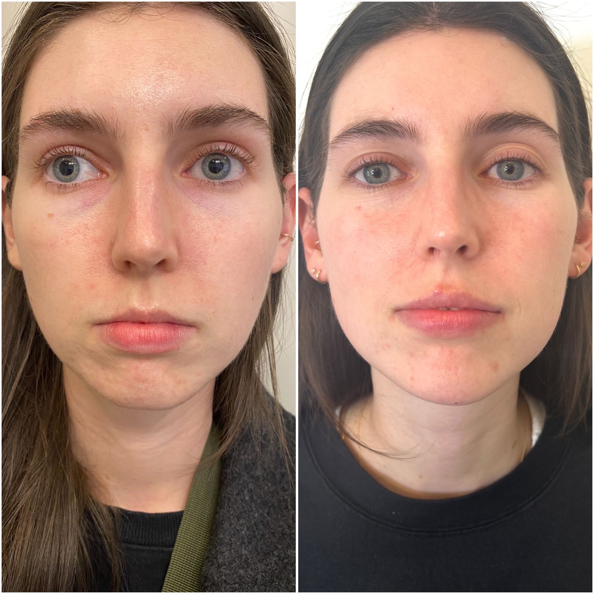 Dermal Filler London ON | Structural Restoration