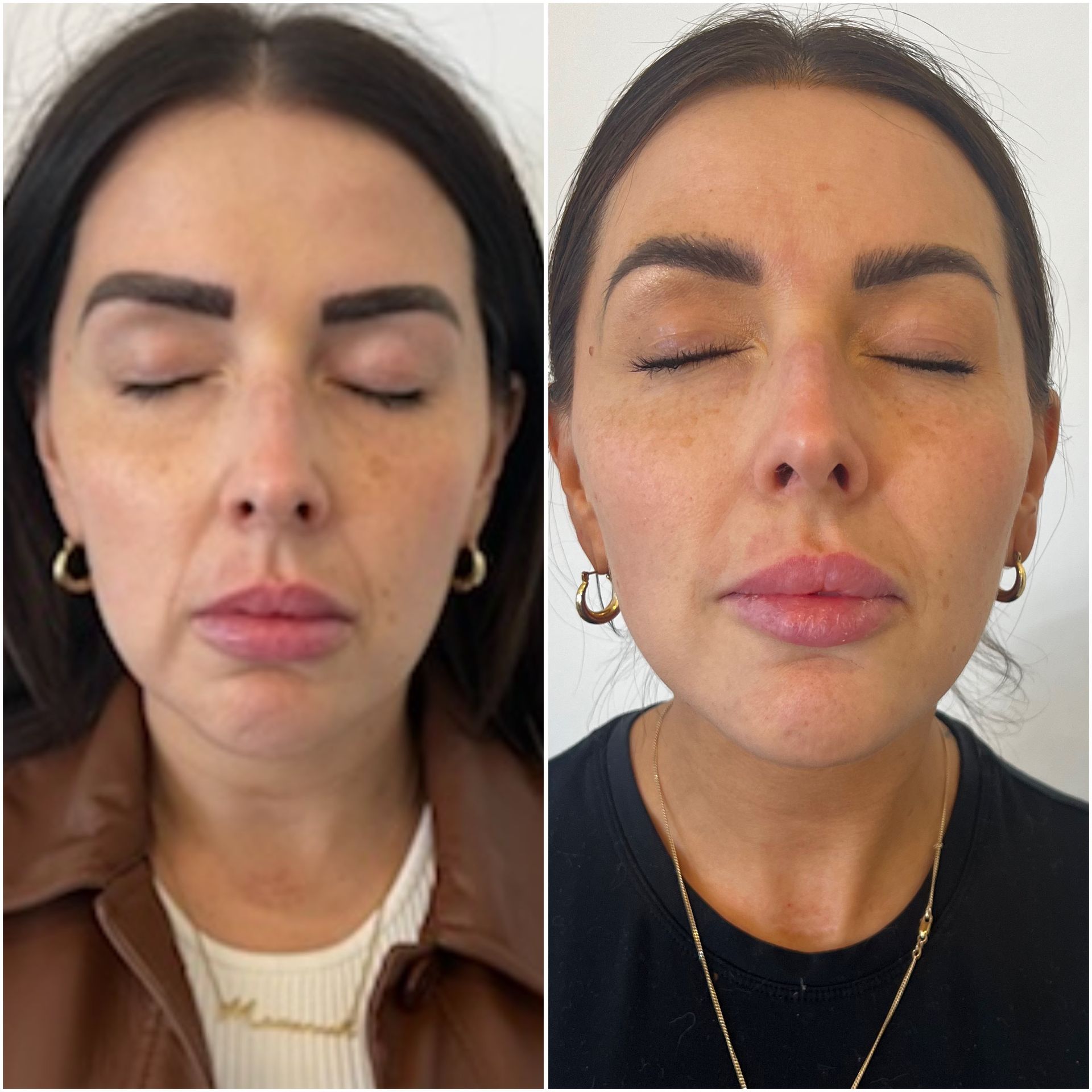 Dermal Filler London ON | Structural Restoration