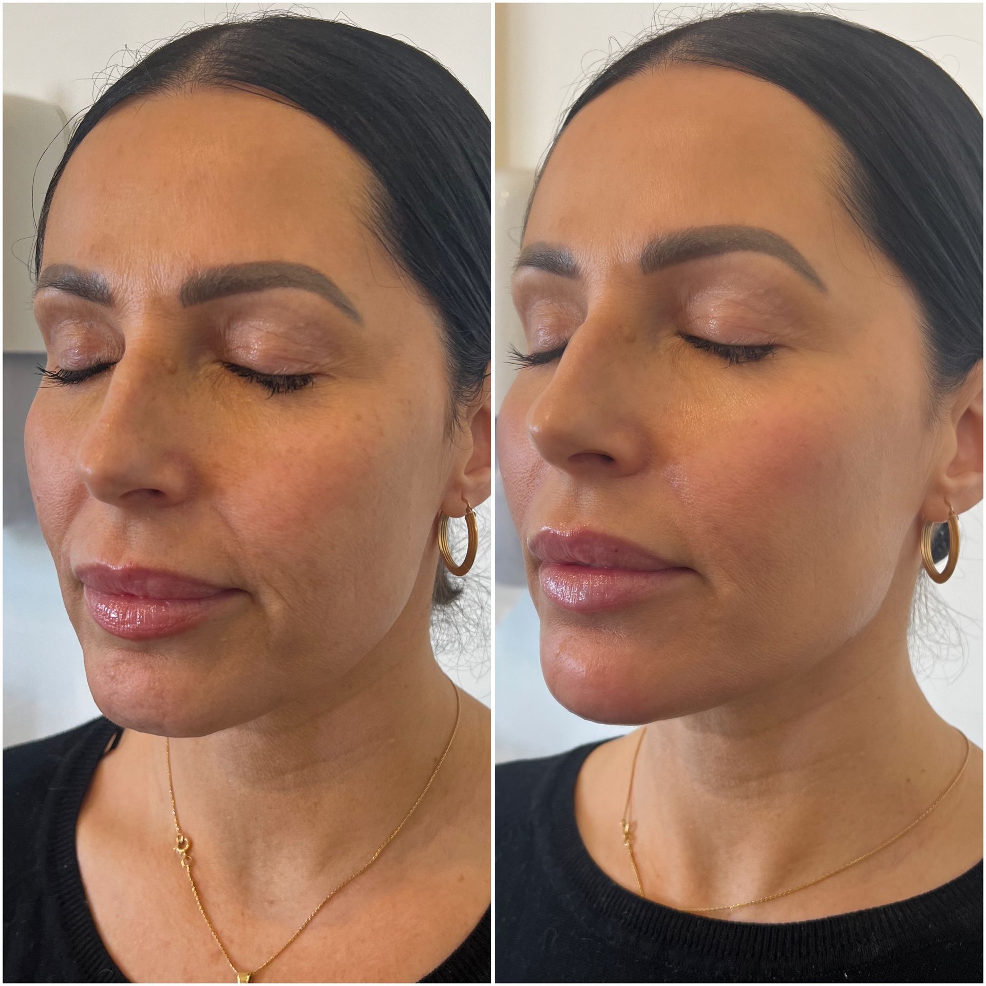 Dermal Filler London ON | Structural Restoration