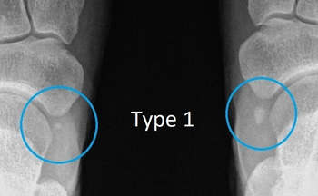 Accessory Navicular | Dr Ben Beamond | Orthopaedic Surgeon | Adelaide