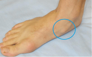 Accessory Navicular | Dr Ben Beamond | Orthopaedic Surgeon | Adelaide
