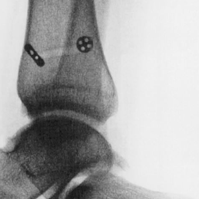 High Ankle Injury | Dr Ben Beamond | Orthopaedic Surgeon | Adelaide