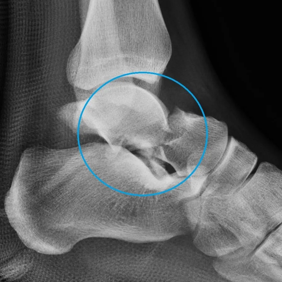 Talus Bone On Xray At Eva Brown Blog Talus Bone On Xray At Eva Brown Blog
