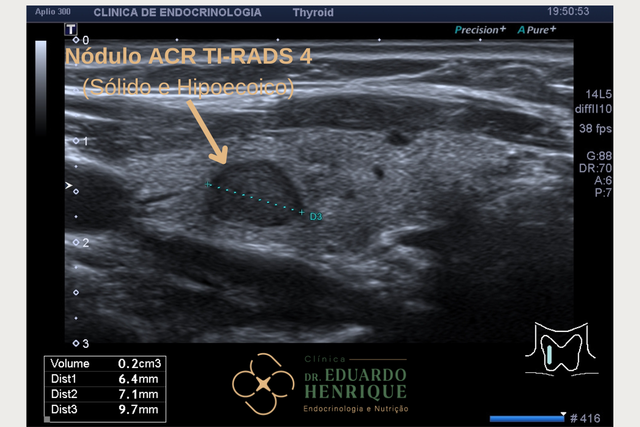 Aparencia Ultrassonografica Do Adenoma Da Tireoide Adenoma De