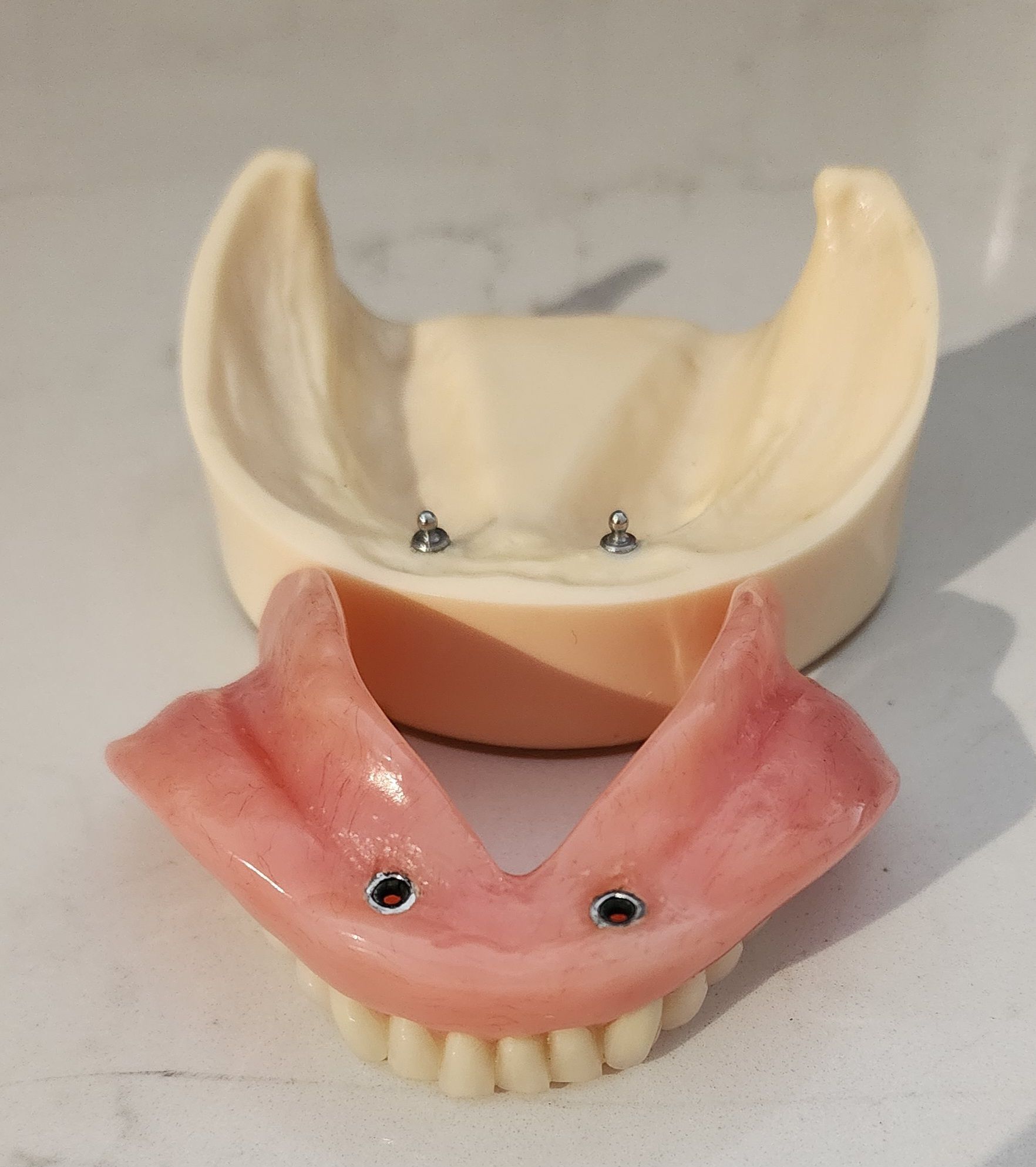 Affordable Implant Dentures in Richmond | Long-Lasting Care
