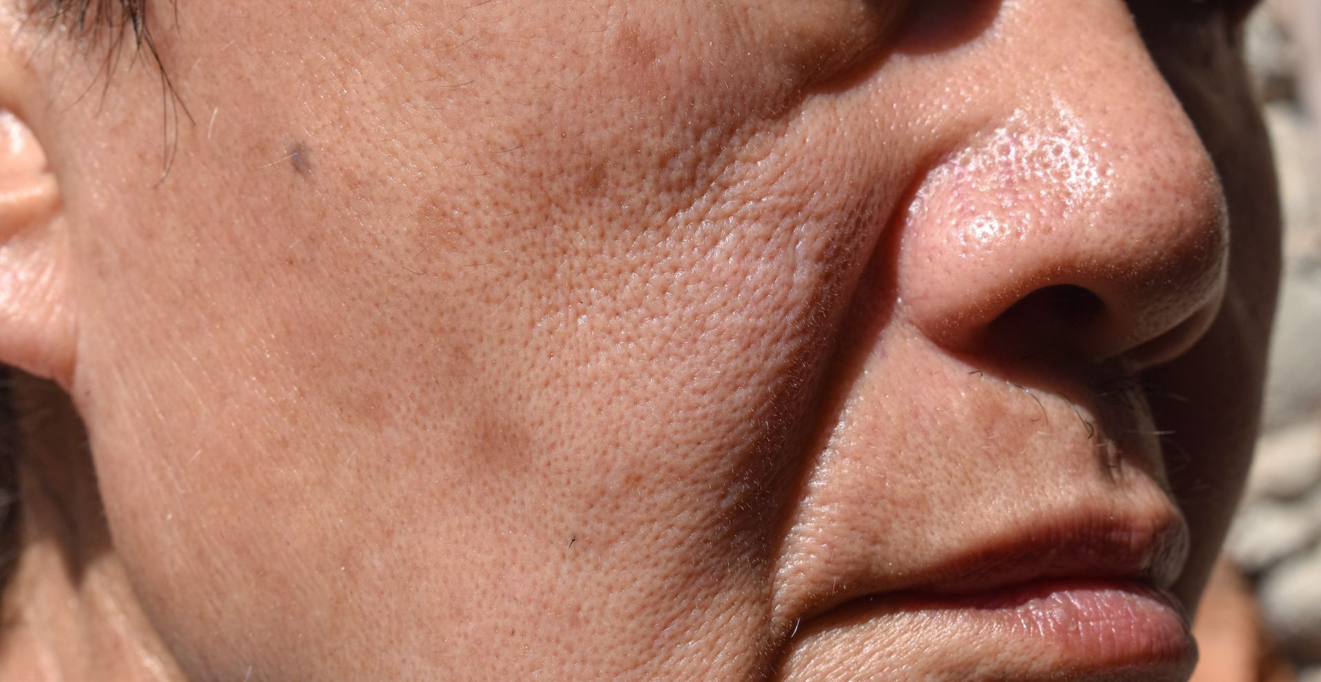 Erase Sun Damage and Uneven Skin Texture with Fraxel Laser | Clearview ...