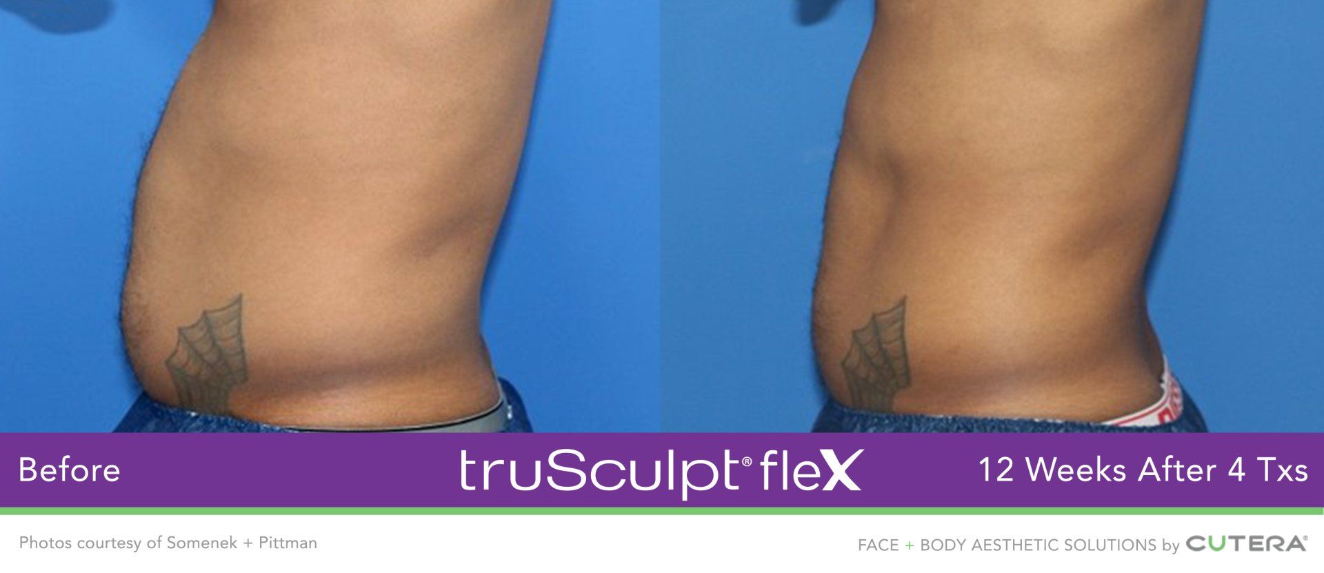 TruSculpt Flex Treatment | Albany, Syracuse, New Hartford, Utica